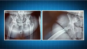 Alternatives to Traditional Total Hip Techniques - Understanding Iliotibial Band Preservation and the Role of Dual Mobility in THA