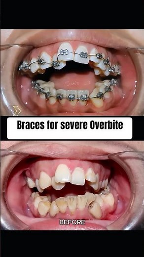 “Transforming Smiles: Braces for Crowding & Overbite”