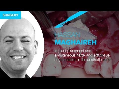 SURGERY: Implant placement + simultaneous hard- and soft tissue augmentation in the aesthetic zone