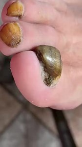 This toenail reveal shocked the entire audience IBOT Beautiful moments of care and relaxation through a gentle pedicure experience. Simple, clean, and satisfying. 🌿✨ Disclaimer: This video is for educational and relaxation purposes only. All content belongs to the respective owners, no copyright infringement is intended. | Tanim