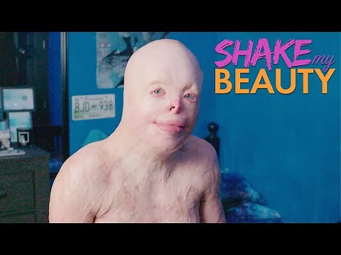 I Have 95% Burns - But I'm Thriving | SHAKE MY BEAUTY
