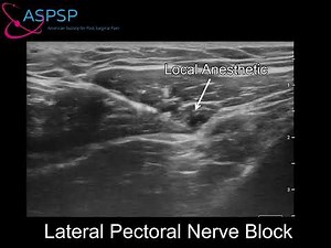 Ultrasound Guided Lateral Pectoral Nerve Block