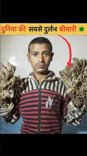 The Rare Condition That Shocks the World: Tree Man Syndrome #shorts #facts