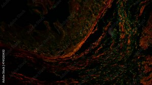 Surface of the human stomach. Malignant and benign neoplasms. 100x magnification. Histologic and cytologic examination of patient biopsy