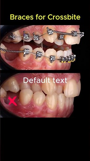 braces transformation. Fix crossbite teeth #braces #dentist #orthodontist