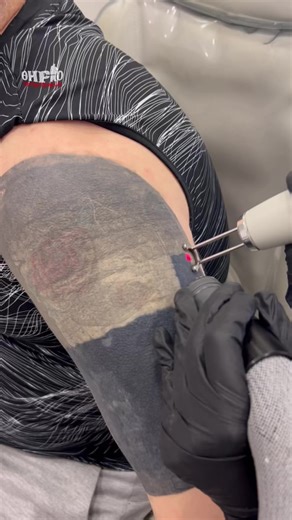 182K views · 765 reactions | Thirio tattoo removal χωρίς πολλά λόγια! #fyp #discoverypico #fractional #afairesitattoo #fractional_laser #DermaPro #ragades #foryou #tattooremoval #fractionallaser #afairesitattoofridion #afairesitatouaz #viral #Thirio #quantasystem #thiriotattooremoval #picolaser #tattoo | Thirio Tattoo Removal | Facebook