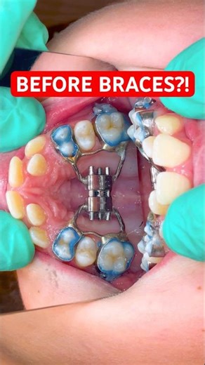 Why Braces Sometimes Start With THIS 😳