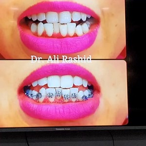All aligned and perfectly straight lower arch, perfect smile for this patient ❤❤. . Lahore Soon. . "Dr. Ali Rashid's Dental Clinic" RJ Mall, 3rd Floor, Gulshan Iqbal Block 10-A, near millennium mall, Karachi Timing: Everyday 12-6 (Friday Sunday off) Contact 1 hour before visiting: 03362048058 | Dr. Ali Rashid