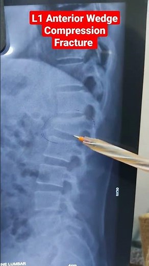 L1 Anterior Wedge Compression Fracture ..Dr Sai Chandra MBBS DNB Ortho