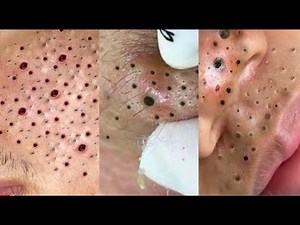 Satisfying Pimple Popping Splinter Blackhead Removing Tiktok compilation 26