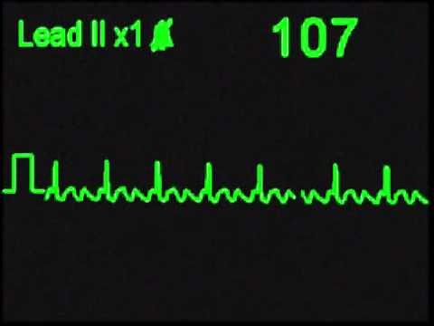 Atrial Flutter 3:1 - ECG Simulator - Arrhythmia Simulator