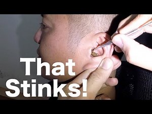 Man's Earwax Blockage Removed Effectively using Ear Curette
