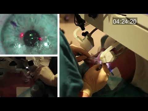 Real-time uncut unedited LASIK procedure live with real sound