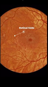 Epiretinal fibrosis (ERF) is a translucent membrane that forms on the internal surface of the retina, more often in the macular area. It occurs as the result of proliferation of cells of glial origin after inflammation, thrombosis or surgical intervention. Details in comment | OPTOMETRISTS