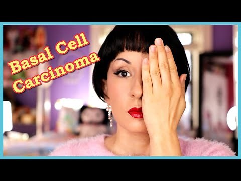 I Had Skin Cancer! Mohs Surgery for Basal Cell Carcinoma and What to Expect.