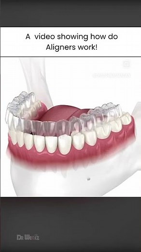 Ever wondered how aligners work? 🤔They apply controlled, gentle pressure to move your teeth.