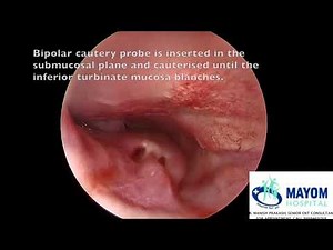 Turbinate Hypertrophy - Submucosal Diathermy Reduction by Dr Manish Prakash Mayom Hospital Gurgaon