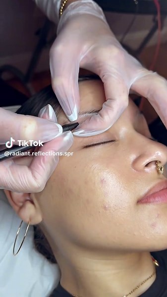 Using Blend, a combination of Electrolysis and Thermolysis to create Lye with addition of heat to kill the Derma papilla or the root of the hair that contains nerves and will completely disable the follicle. This is the only FDA approved permanent hair removal method. #electrolysis #beauty