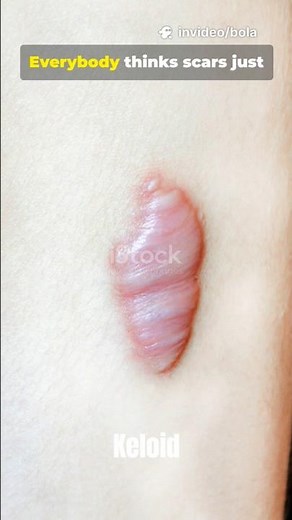 Keloid Scar Explained | Causes, Symptoms, Treatment & Prevention