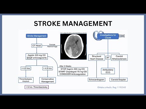 Stroke Management Explained
