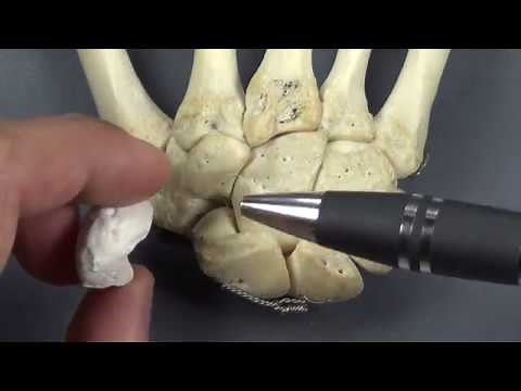 Lunate Anatomy and Osteology with Clinical Correlations and Side Determination