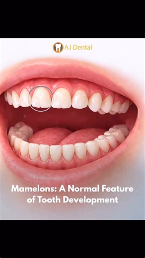 AJ Dental on Instagram: "Mamelons are small, natural bumps on newly erupted permanent front teeth, commonly seen in children and teens. They usually don’t need treatment unless they affect appearance or bite comfort. #dentaleducation #dental #oralhealtheducation #danburyct #dentalct"
