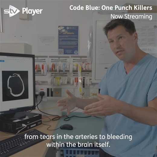 3.1K views · 12 reactions | ⚠️ A doctor shows the fatal dangers of just one punch. https://stv.click/code-blue-killer | STV | Facebook