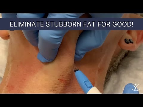 Double Chin Treatment WITHOUT Surgery | Agnes RF