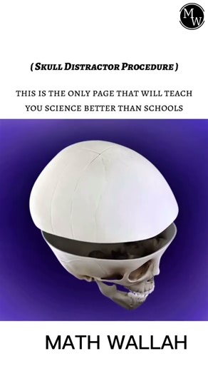 🔬 Skull Distractor: The Science of Bone Regrowth!