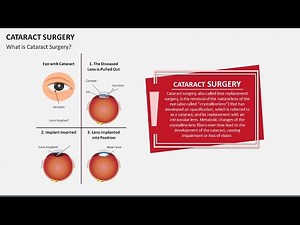 Cataract Surgery Animated PowerPoint Slides