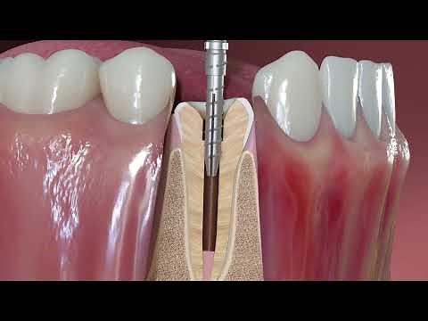 Flexi-Post inserted into the root canal space