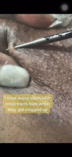 Effective Sinus Tract Extraction Techniques