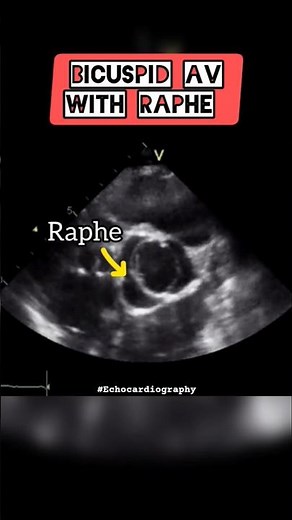 Bicuspid Aortic Valve #heart #echocardiography