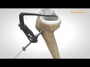 meniscal root tears repair