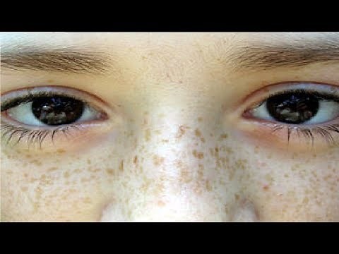 how to get rid of freckles in 5 minutes