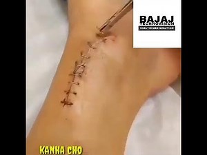 How to Safely Remove Skin Staples Using a Staple Extractor | Step-by-Step Guide |