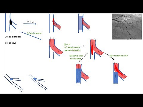 Ostial side branch stenting (esp. ostial diagonal): algorithms and cases -Elias Hanna
