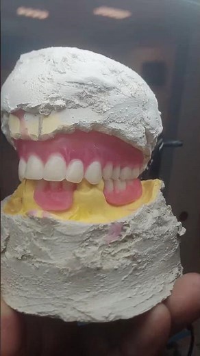 upper complete denture lower partial denture tooth setup#sedationdentistry #partialdenture