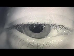 BPPV Nystagmus during Dix Hallpike Maneuver