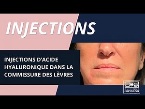 Injections d'acide hyaluronique dans la commissure des lèvres pour redresser un bouche tombante