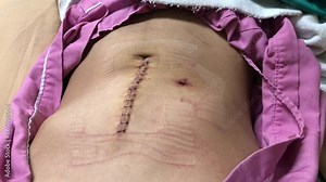 Abdomen of middle age man has wound,has Metal staple on wound,after surgery due to leaky intestines and stomach,selective focus.