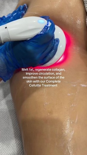 ✨ Say Goodbye to Cellulite and Hello to Smooth, Firm Skin—Now with Black Friday Deals! ✨ Ready to tackle cellulite and feel confident this summer? Book a FREE consultation and let our expert therapists help you achieve smoother, firmer skin with our advanced, multi-step cellulite treatments! Why Choose Us for Cellulite Reduction? Cellulite forms when fat cells expand beneath the skin’s surface, creating a dimpled appearance. Combined with a loss of elasticity, it can be tough to manage alone. Bu