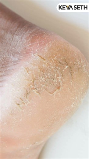 Painful Heel Cracks? Try This Peepal Leaf Home Remedy | Keya Seth Aromatherapy
