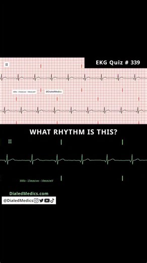 Dialed Medics 💔 🚑 🚁 🏥 ❤️ | ↕️🫀🤔 All #EKG recordings are from the EKG rhythm generator on my website (LII rhythms only for now, 12Ls are in beta and coming soon), be... | Instagram