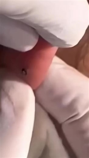 #pimplepoppersatisfying #blackhead #pimple