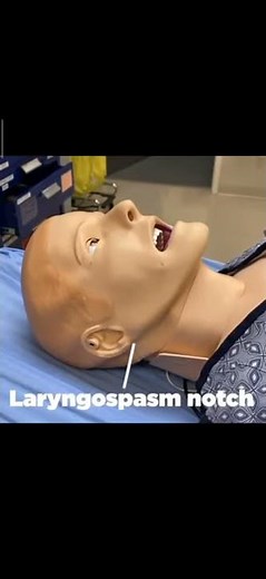 Laryngospasm notch ( Larson's point ) Stridor ✓ Jaw thrust maneuver ✓ #shortvideo