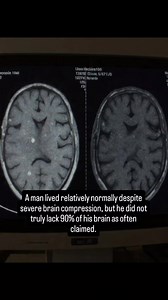 A rare medical case shows how adaptable the human brain can be. | Facts 18