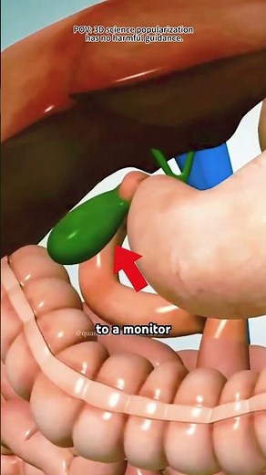 How Gallbladder Removal Surgery Is Performed (3D Animation)