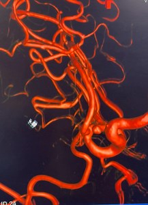 হার্টের যেমন angiogram করা হয় তেমনি হ্রেইনের ও এ‍্যাম্জিওগ্রাম করা হয়। Brain Angiogram কখন করবেন? উত্তরঃ ১) হঠাৎ তীব্র মাথা ব্যথা হলে যে ব্যথা এর আগে অনুভূত হয় নাই॥ ২)Brain stroke করলে ৩) Brain এ #AVM থাকলে ৪)মাথা ব্যথার পরে অজ্ঞান হয়ে গেলে। ৫)brain এ Aneurysm থাকলে। | Isma Azam Zico