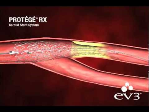 Embolic Protection Device